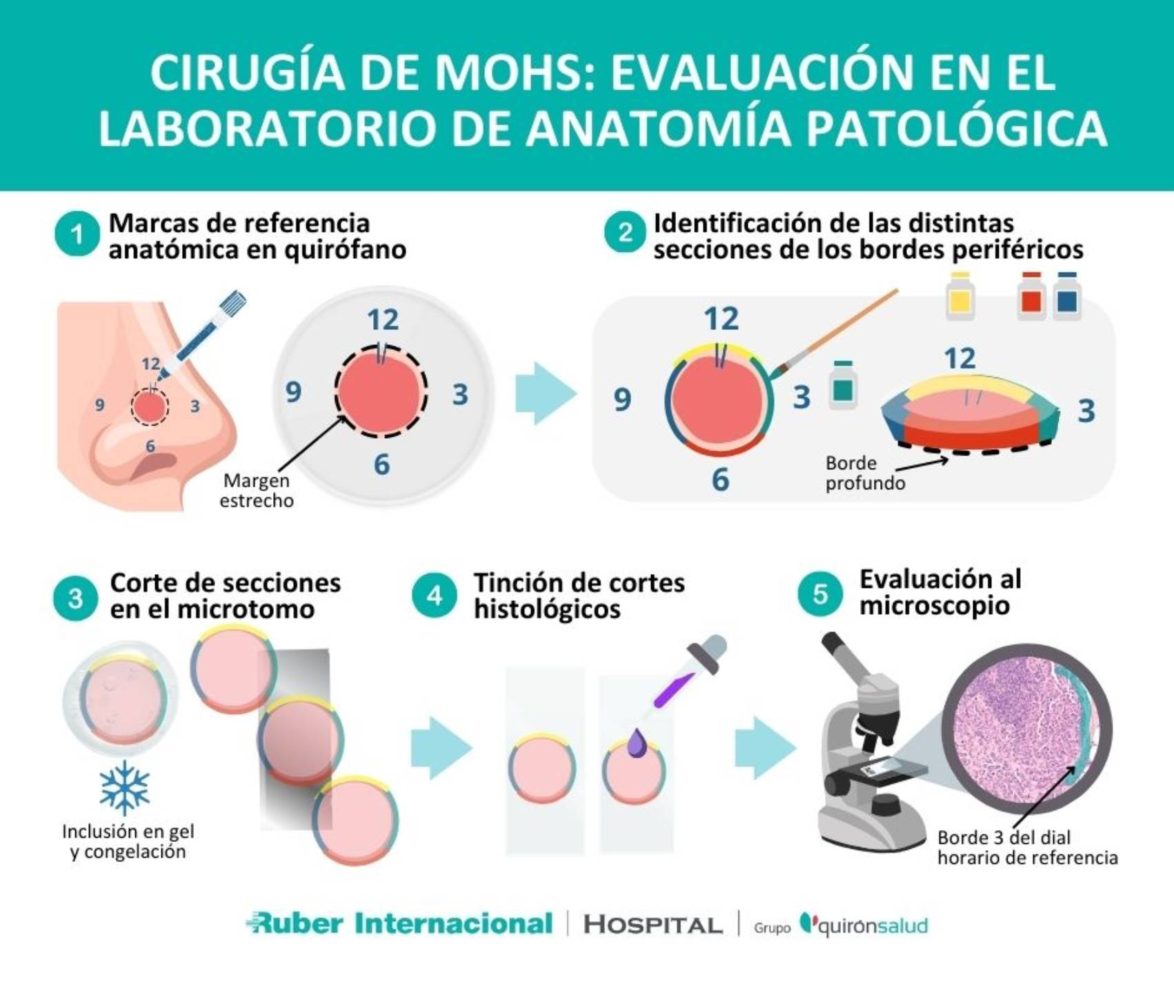 Cirugía de Mohs: Tratamiento del Carcinoma Basocelular en la piel de la cara